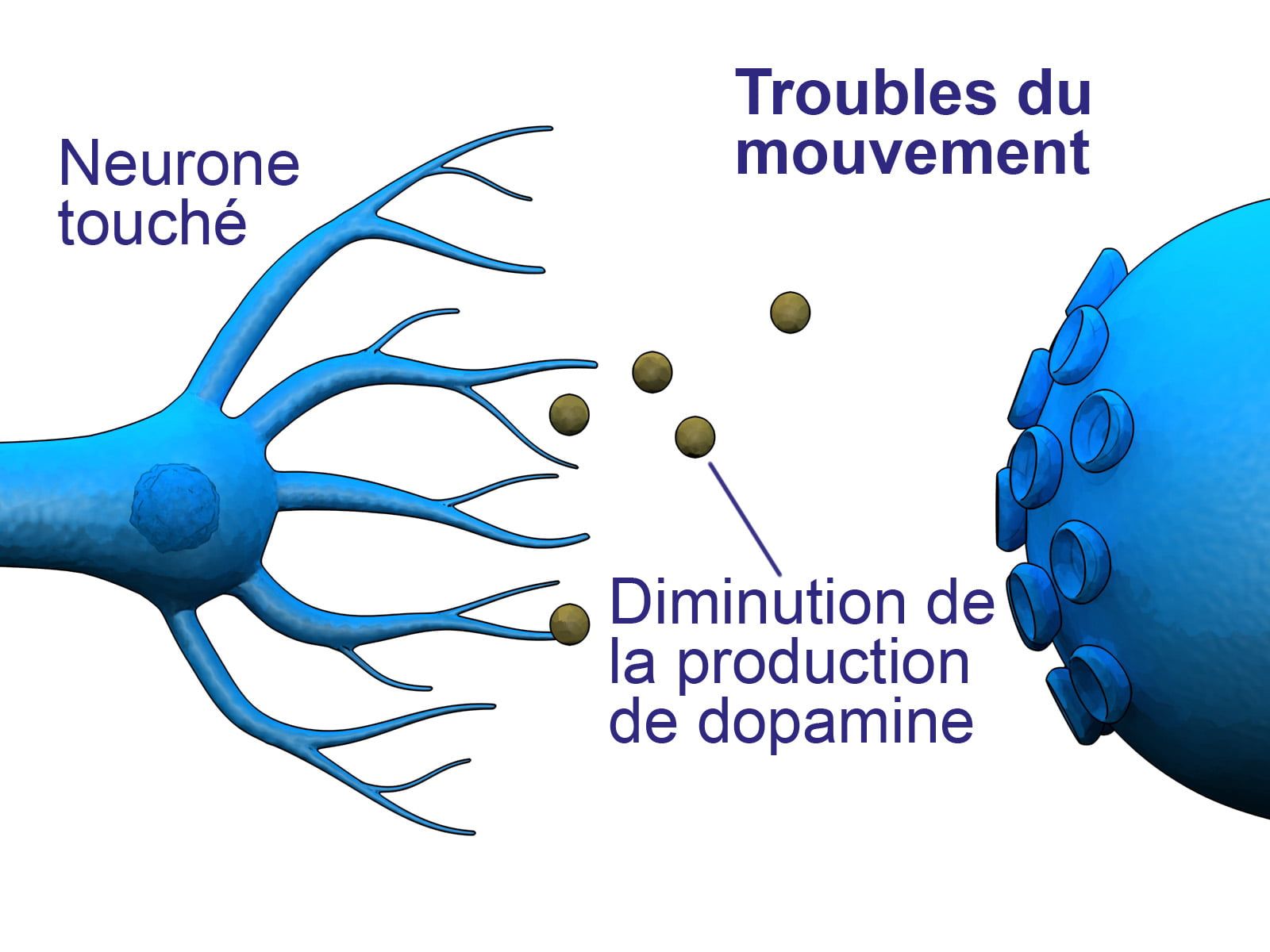 Parkinson : quand l’orthophonie aide les malades | e-orthophonie